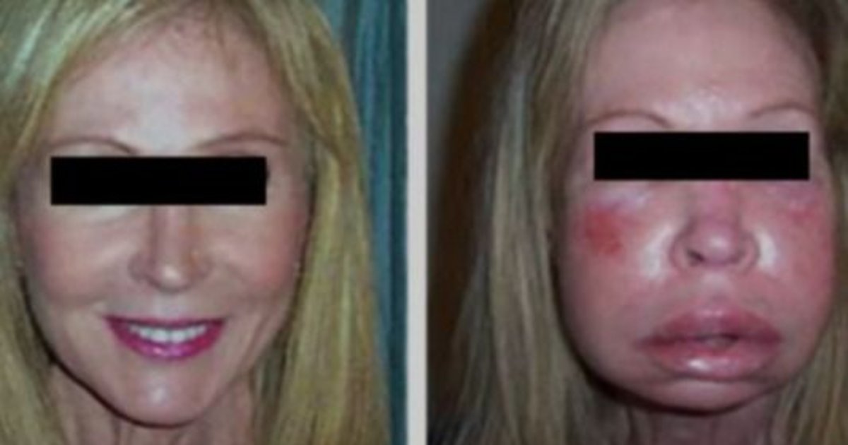 ¿Qué es el angioedema hereditario, cuáles son sus síntomas y cómo se trata?